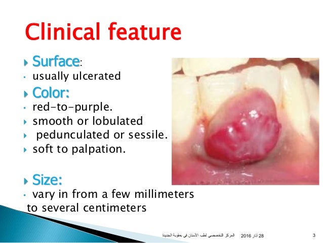 Oral pyogenic granuloma