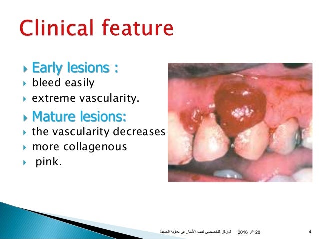 Oral pyogenic granuloma