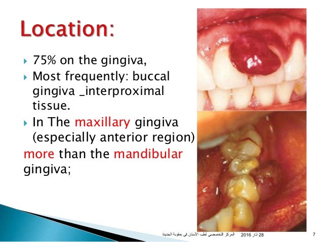 Oral pyogenic granuloma