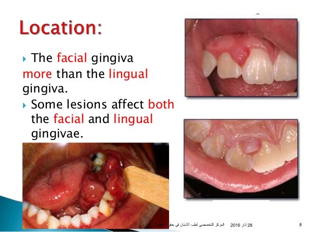 Oral Pyogenic Granuloma