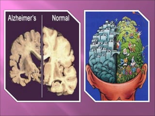 alzhaimer | PPT