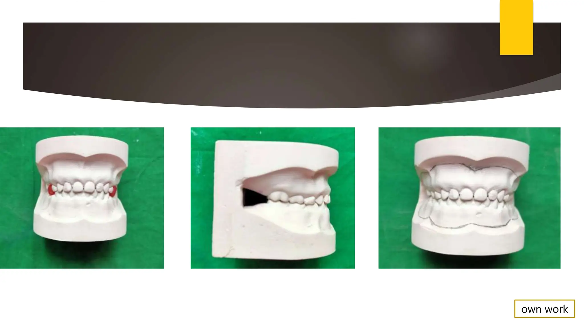 ORAL SCREEN in ortho patients- a case report | PPTX