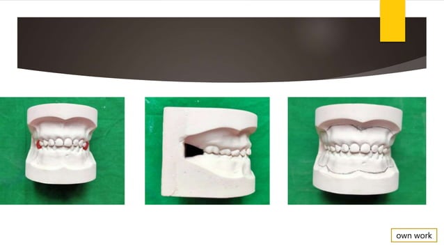 ORAL SCREEN in ortho patients- a case report | PPTX