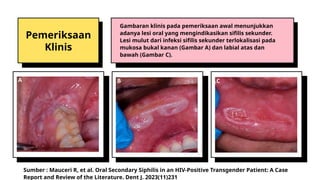Oral Secondary Syphilis in an HIV-Positive Transgender Patient A Case ...