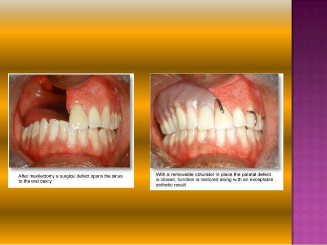 Oral squamous cell carcinoma