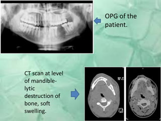 NON ODONTOGENIC TUMORS OF ORAL CAVITY-I | PPTX