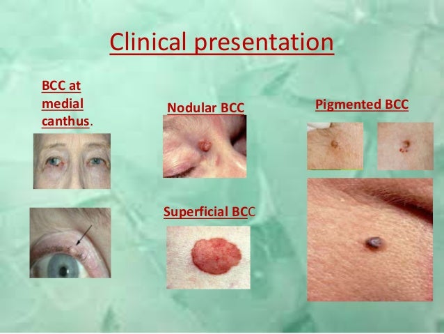 NON ODONTOGENIC TUMORS OF ORAL CAVITY-I