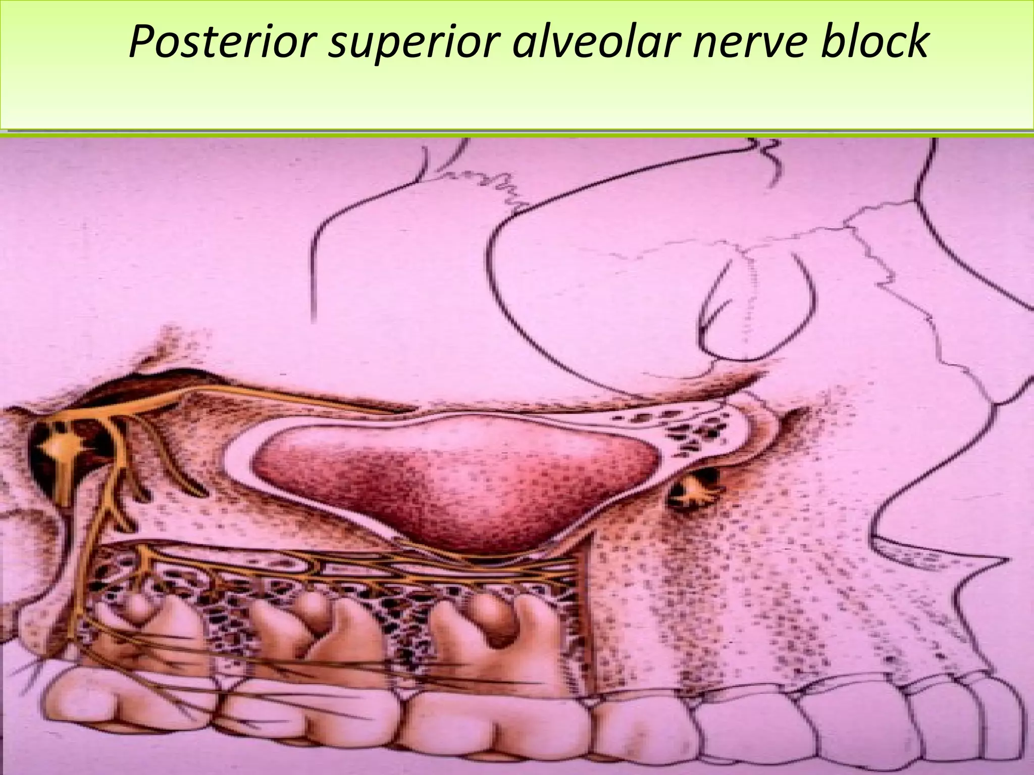 maxillary nerve blocks | PPT