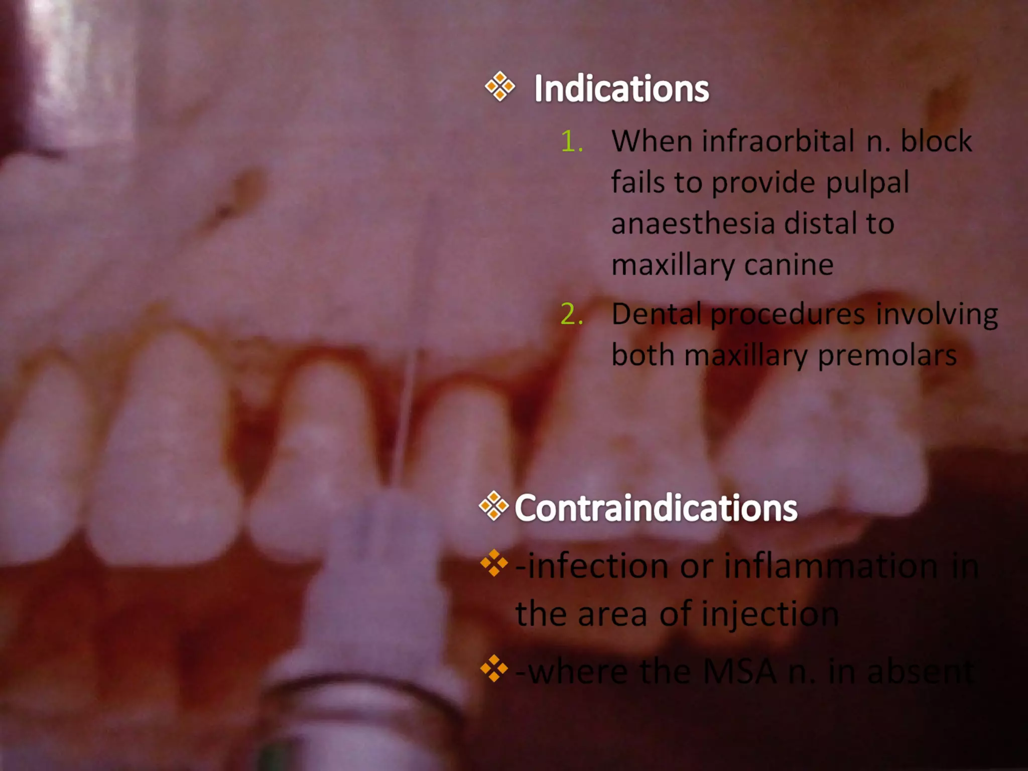 maxillary nerve blocks | PPT