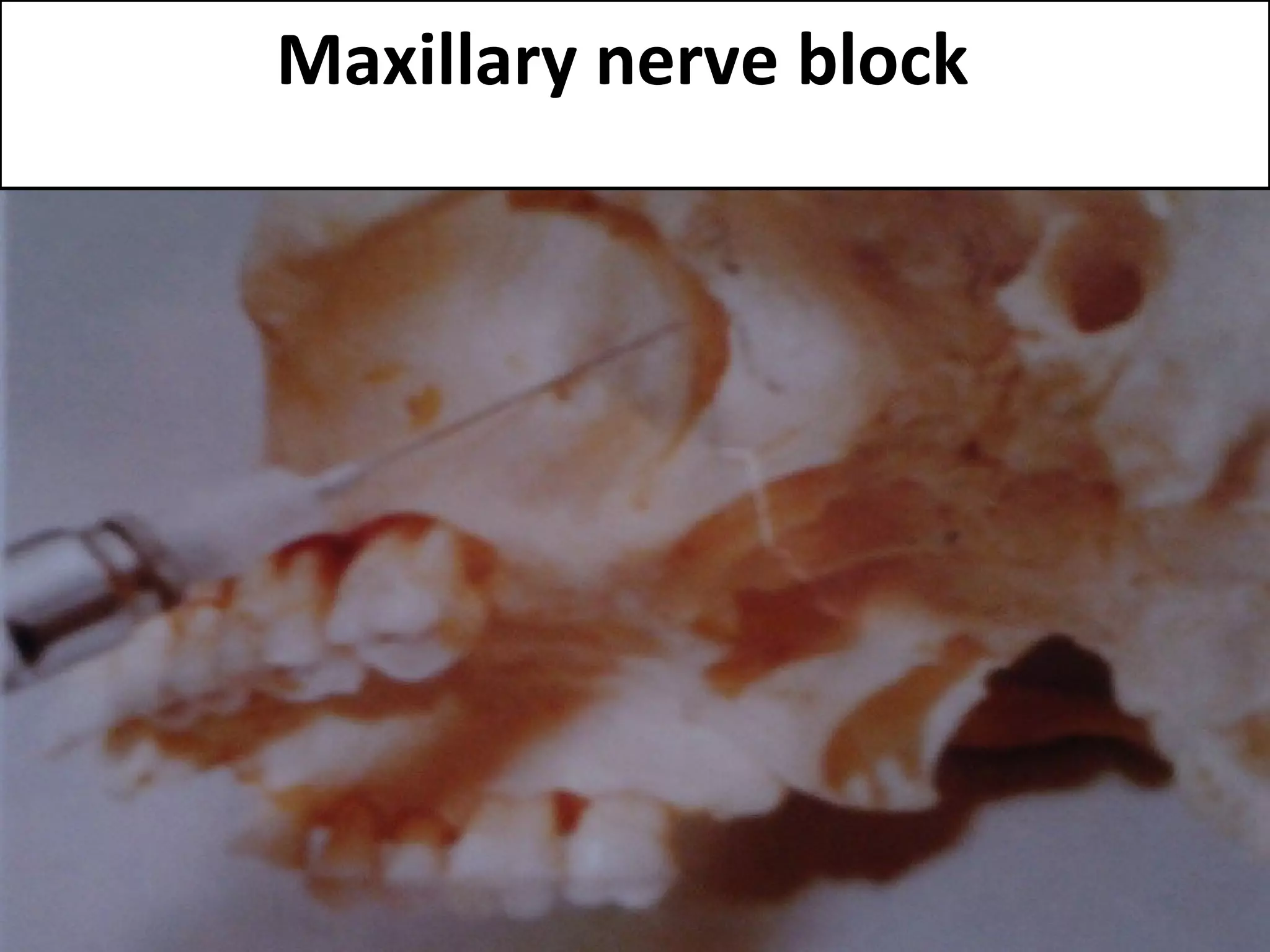 maxillary nerve blocks | PPT