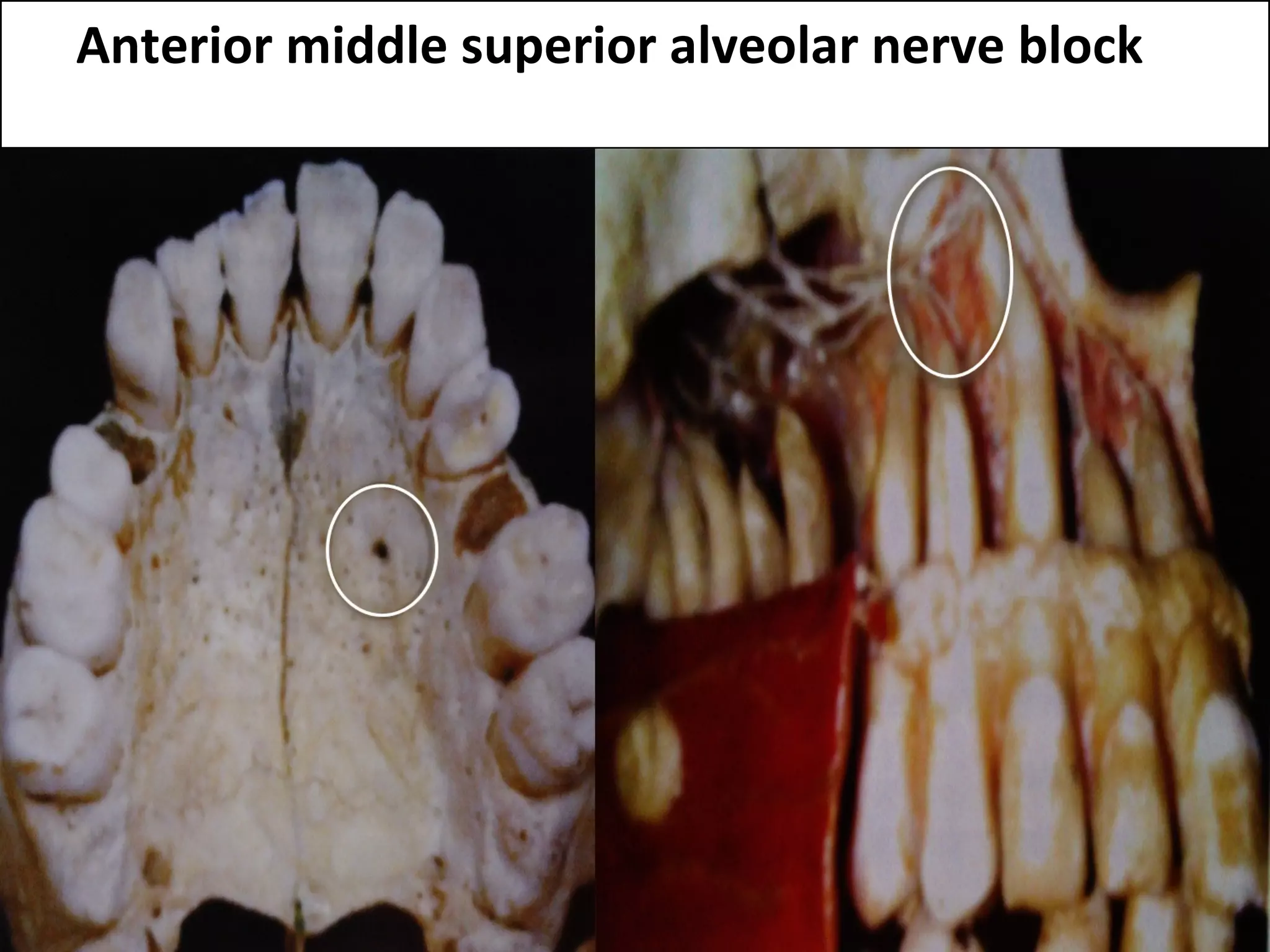 maxillary nerve blocks | PPT