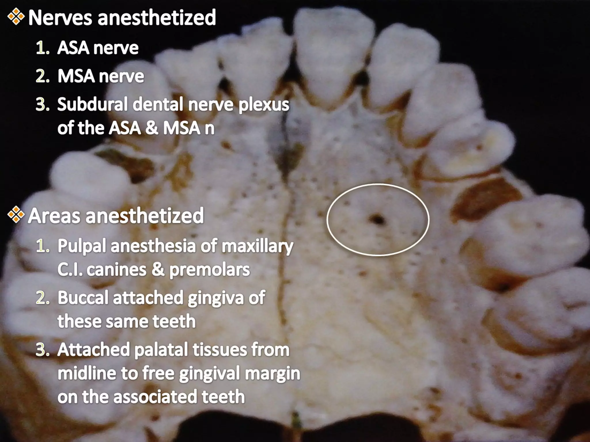 maxillary nerve blocks | PPT