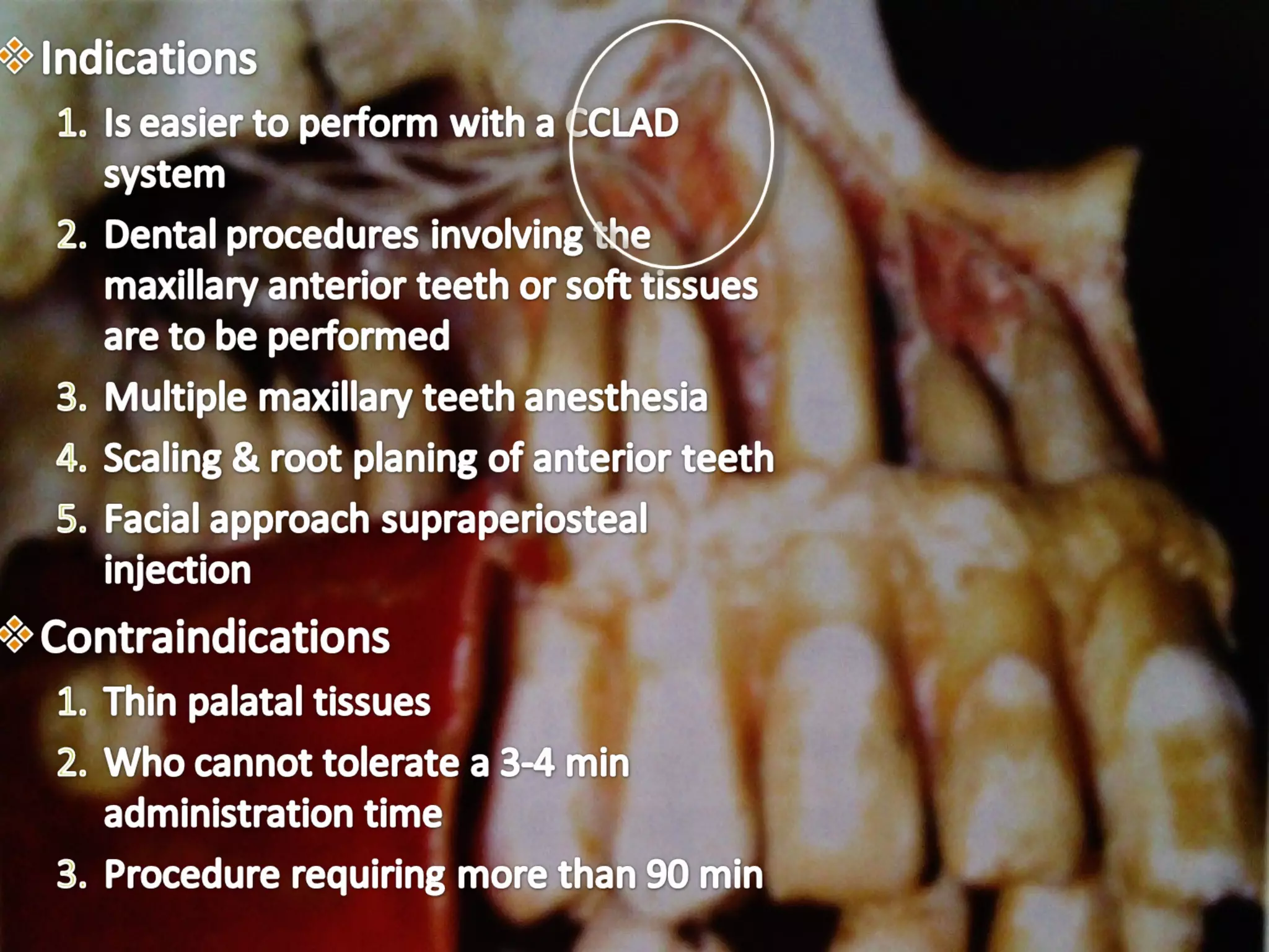 maxillary nerve blocks | PPT