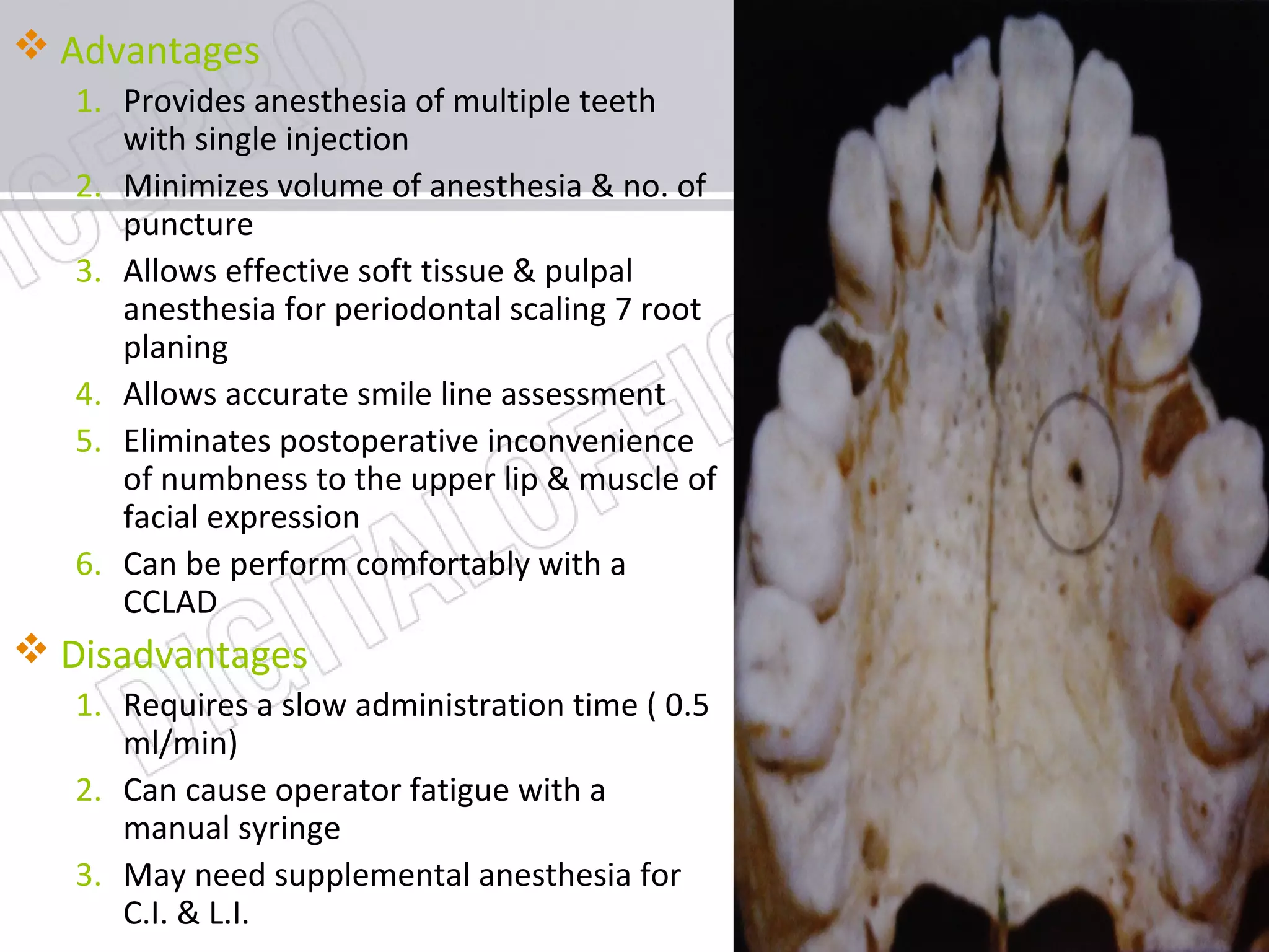 maxillary nerve blocks | PPT