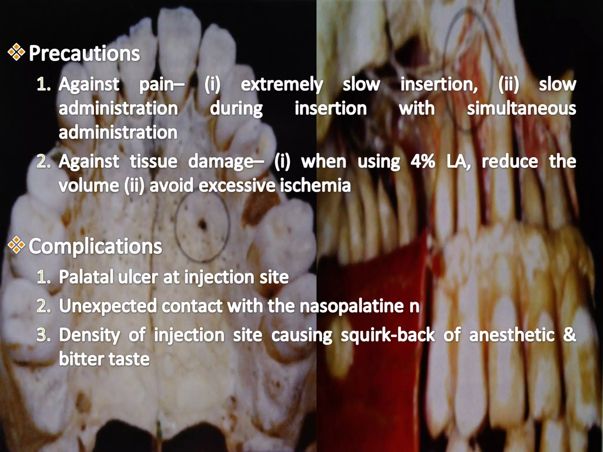 maxillary nerve blocks | PPT