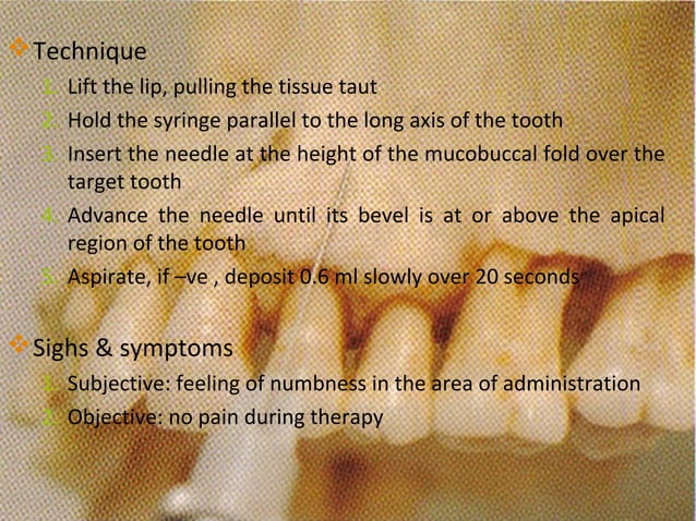 maxillary nerve blocks | PPT