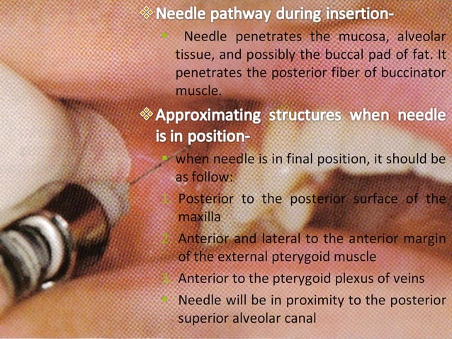 maxillary nerve blocks | PPT