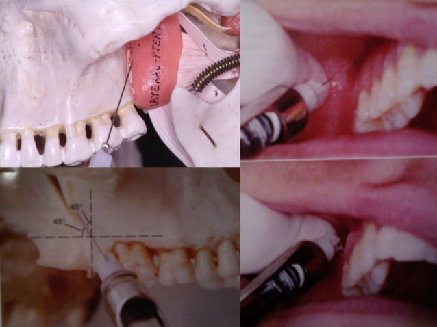 maxillary nerve blocks | PPT