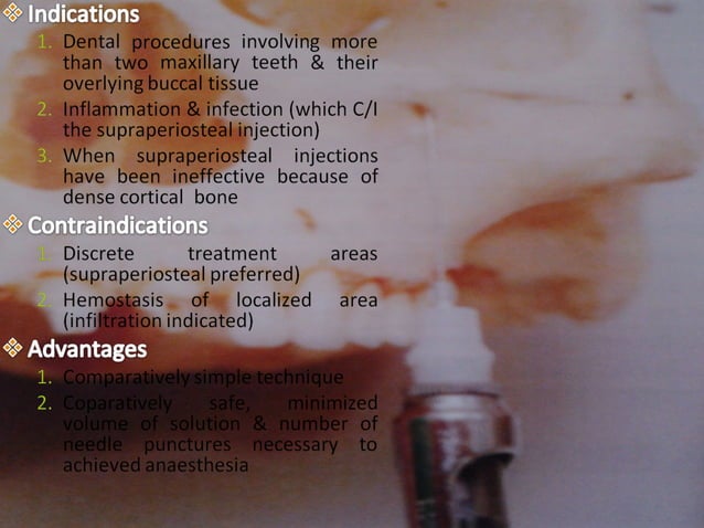 maxillary nerve blocks | PPT