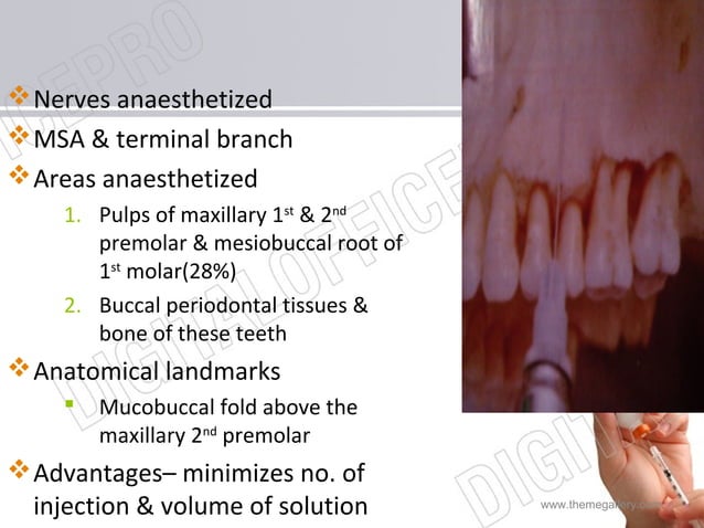 maxillary nerve blocks | PPT
