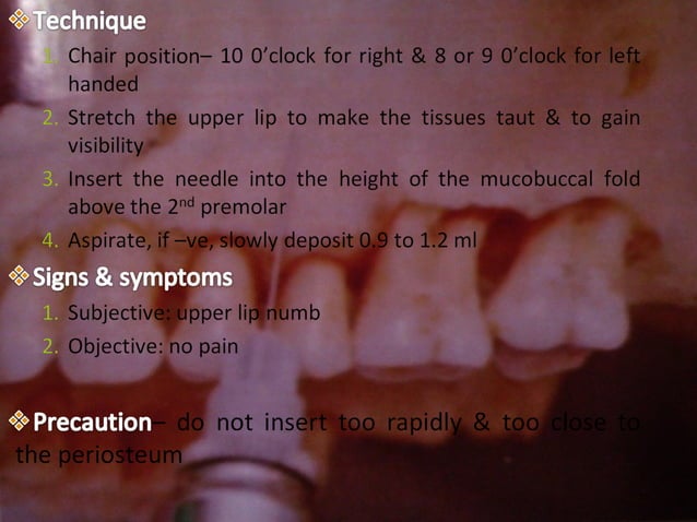 maxillary nerve blocks | PPT