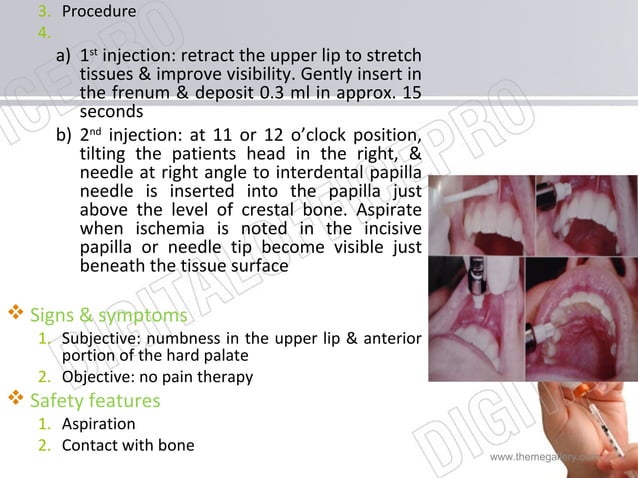 maxillary nerve blocks | PPT