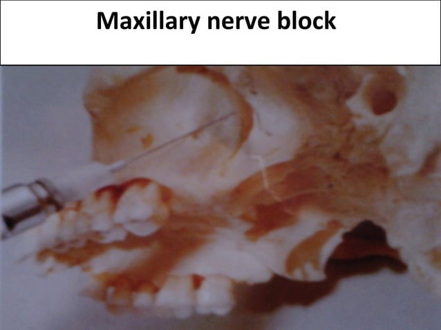 maxillary nerve blocks | PPT