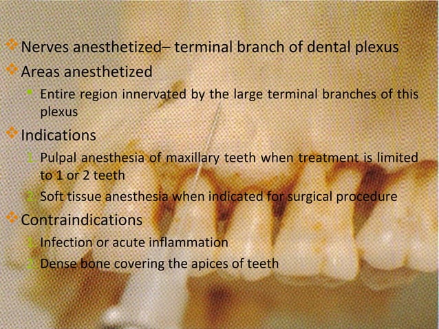 maxillary nerve blocks | PPT