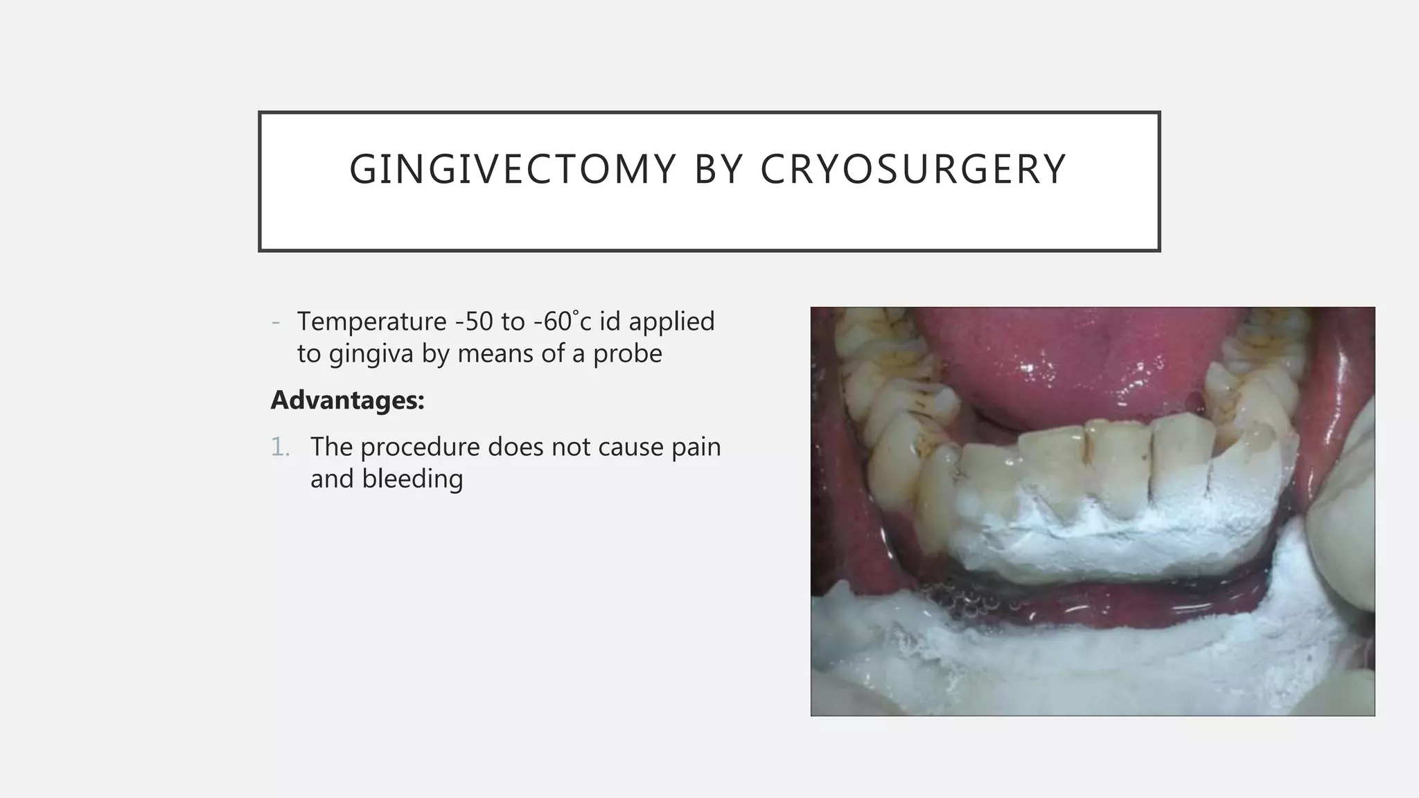 Gingivectomy (oral surgery) | PPTX
