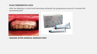 Gingivectomy (oral surgery) | PPTX