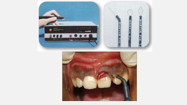 Gingivectomy (oral surgery) | PPTX