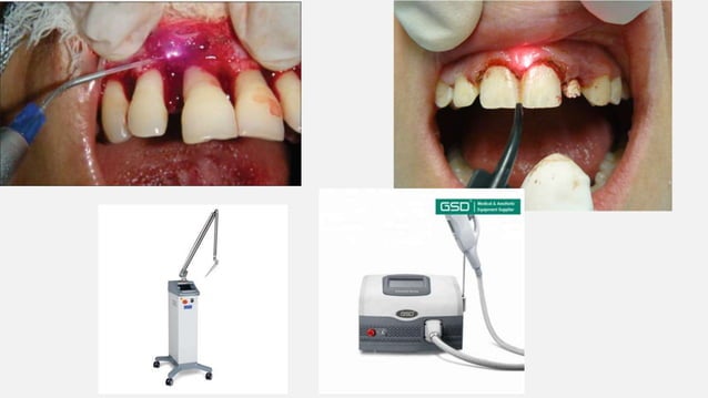 Gingivectomy (oral surgery) | PPTX