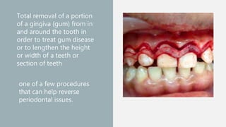 Gingivectomy (oral surgery) | PPTX