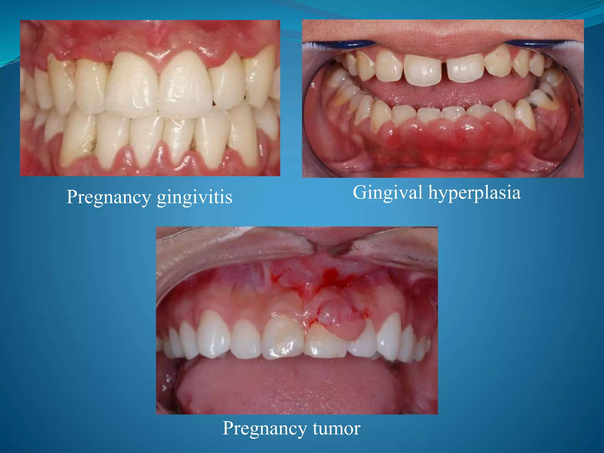 Oral surgery during pregnancy | PPTX