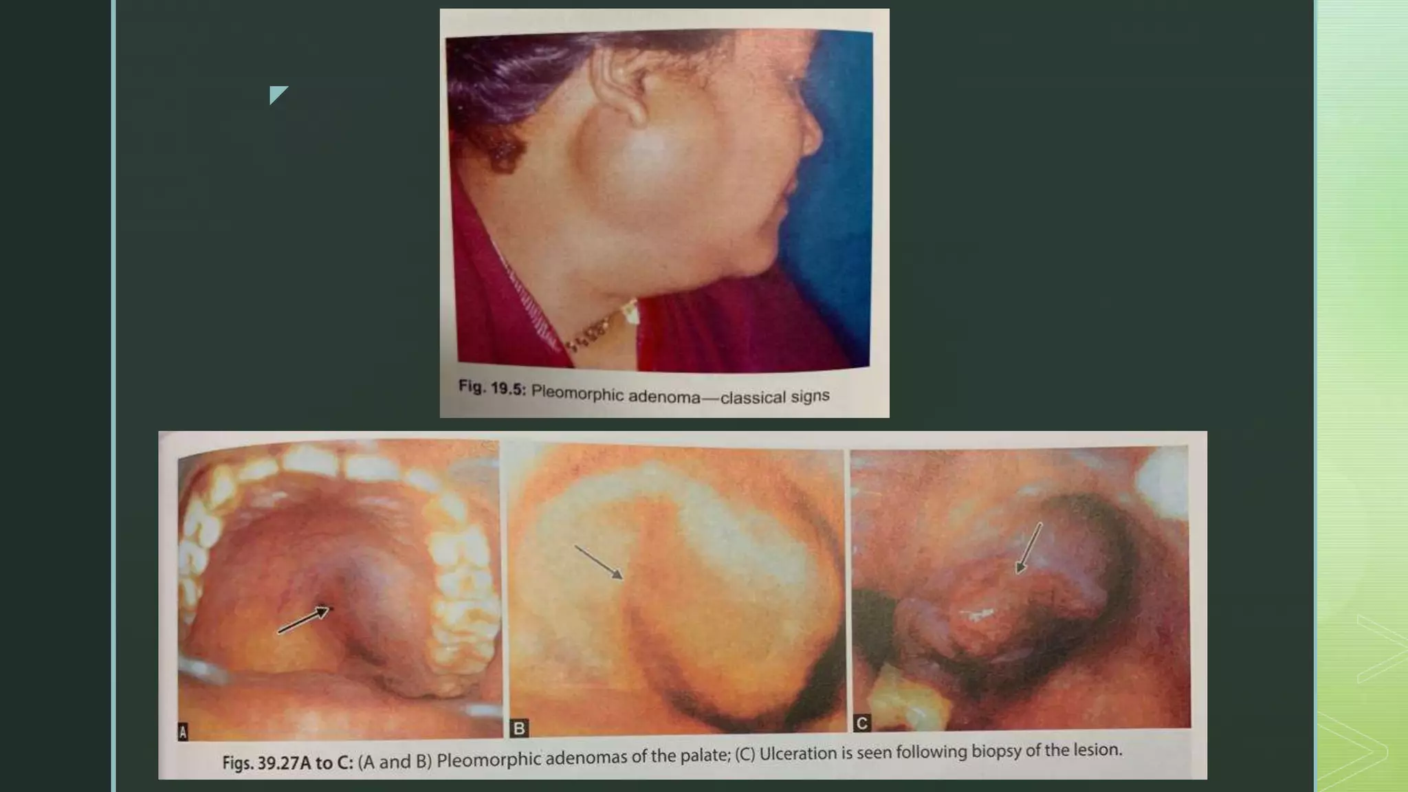 salivary glands tumors | PPTX