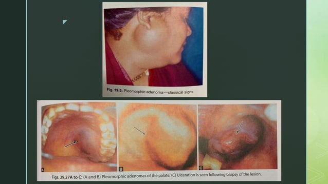 salivary glands tumors | PPTX | Ear, Nose and Throat Conditions | Diseases and Conditions