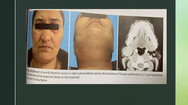 salivary glands tumors | PPTX | Ear, Nose and Throat Conditions | Diseases and Conditions