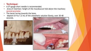oral surgery - techniques of local anesthesia powerpoint | PPTX
