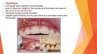 oral surgery - techniques of local anesthesia powerpoint | PPTX