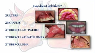 Oral tuberculosis