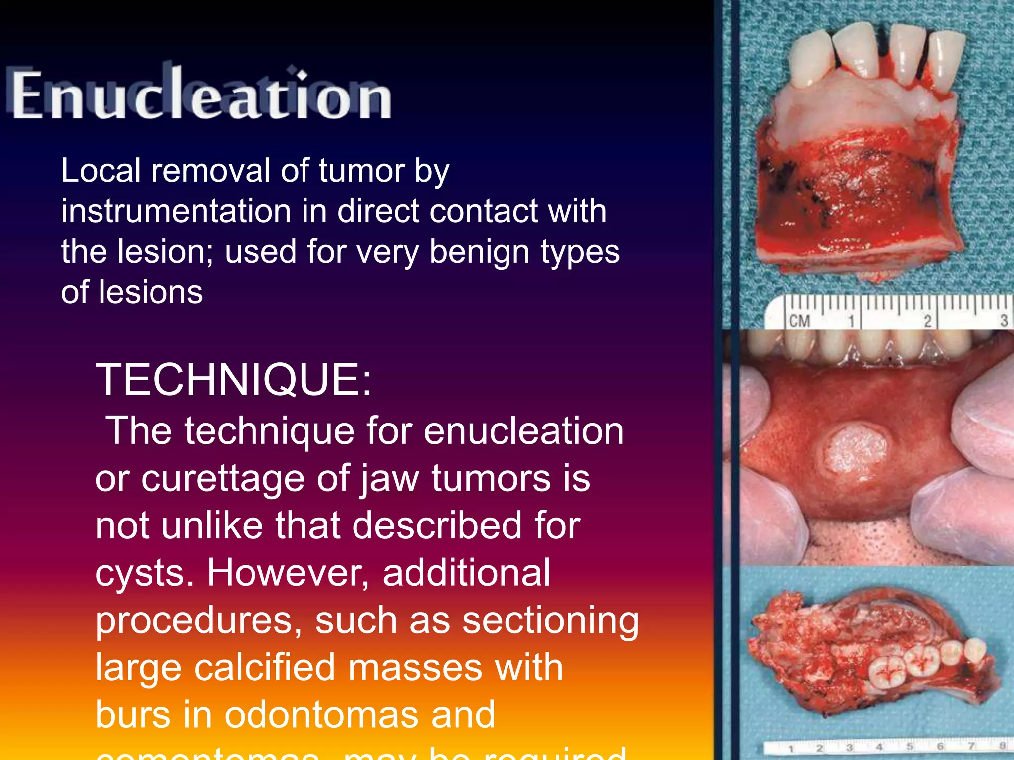 Surgical Management of Jaw Tumors and Other Oral Cavity Tumors | PPTX