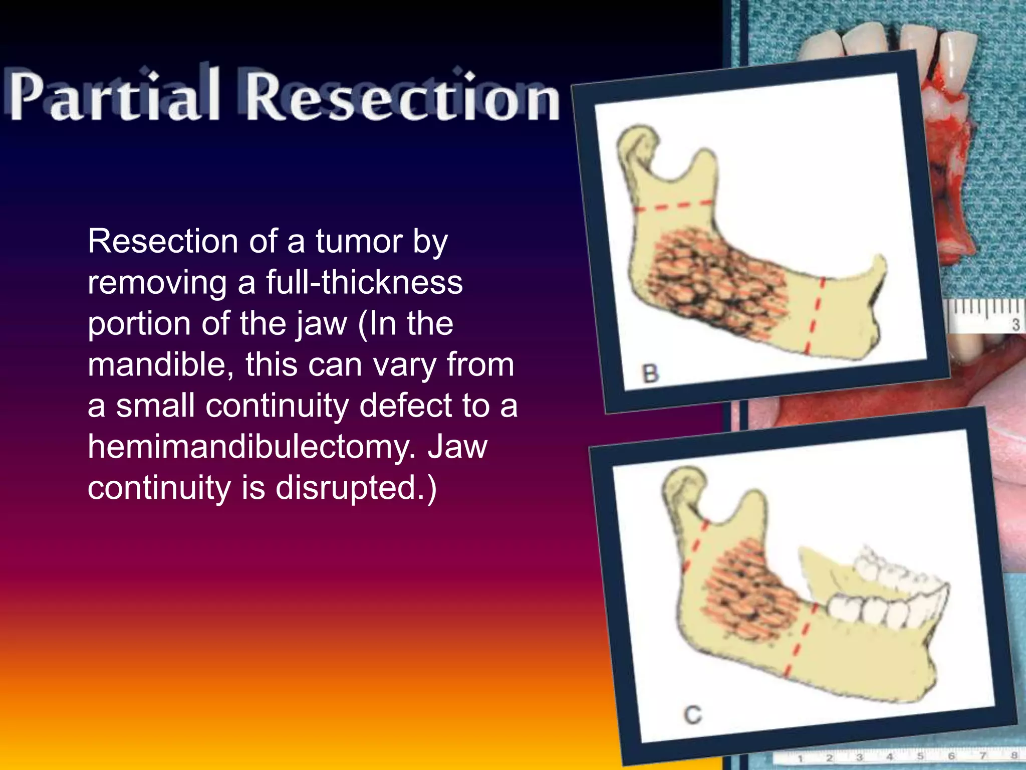 Surgical Management of Jaw Tumors and Other Oral Cavity Tumors | PPTX