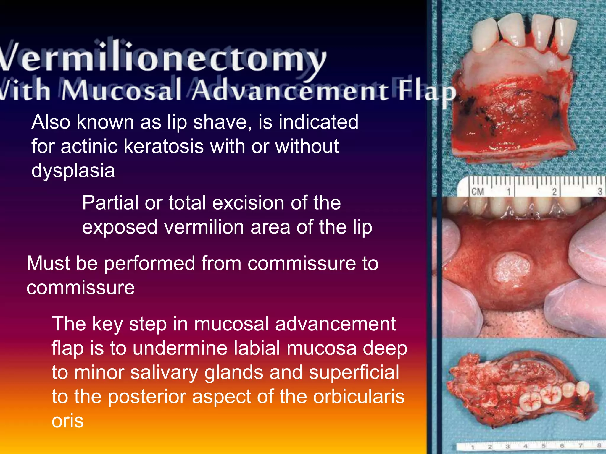 Surgical Management of Jaw Tumors and Other Oral Cavity Tumors | PPTX