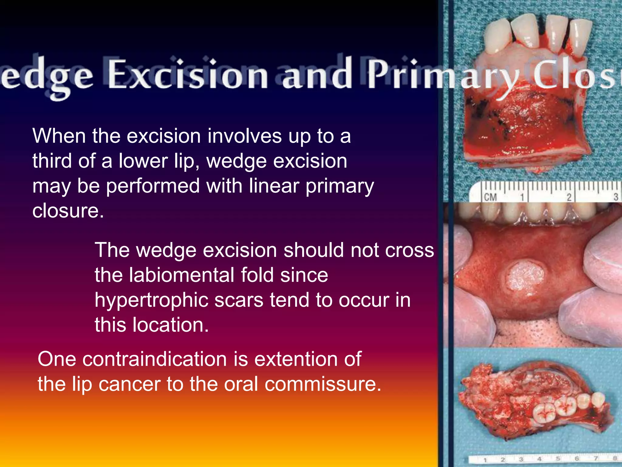 Surgical Management of Jaw Tumors and Other Oral Cavity Tumors | PPTX