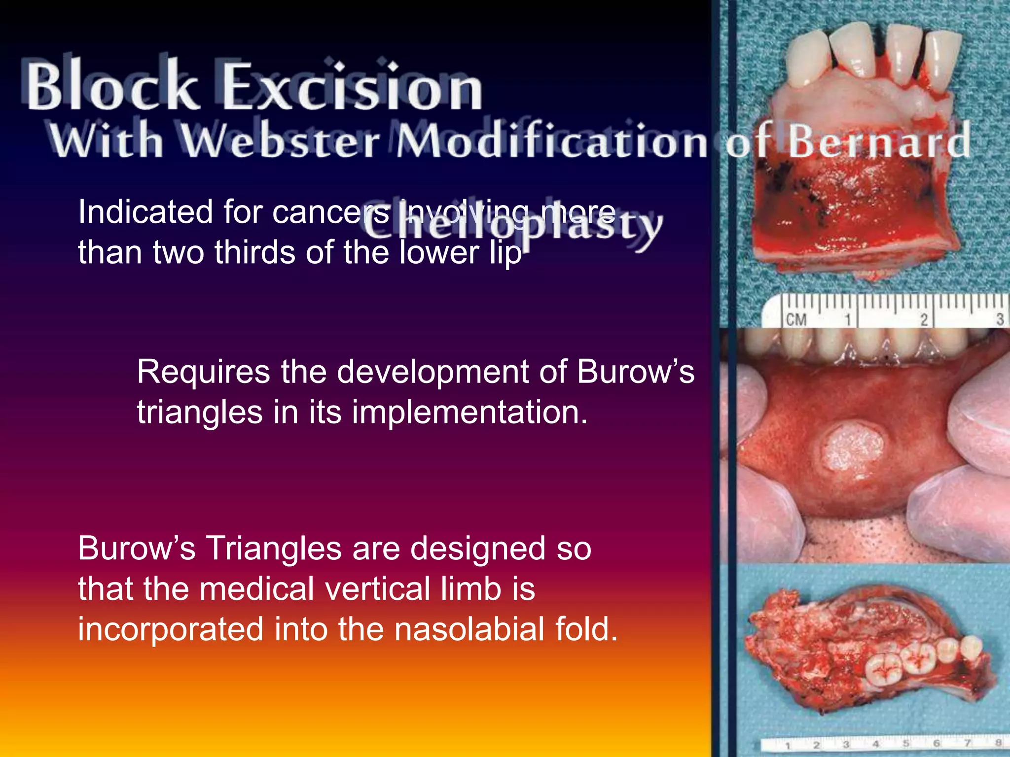Surgical Management of Jaw Tumors and Other Oral Cavity Tumors | PPTX