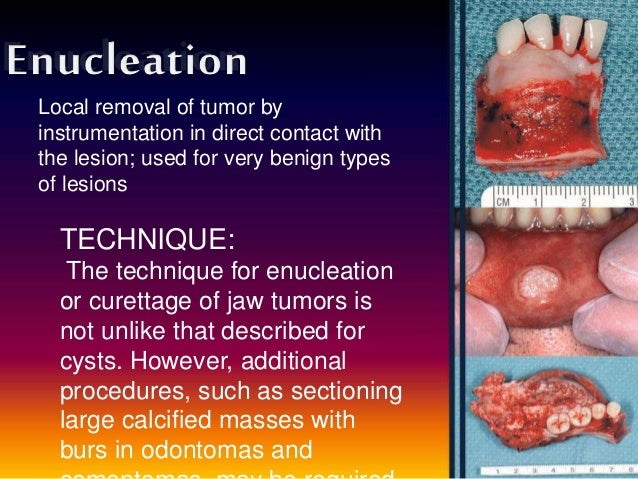 Surgical Management of Jaw Tumors and Other Oral Cavity Tumors