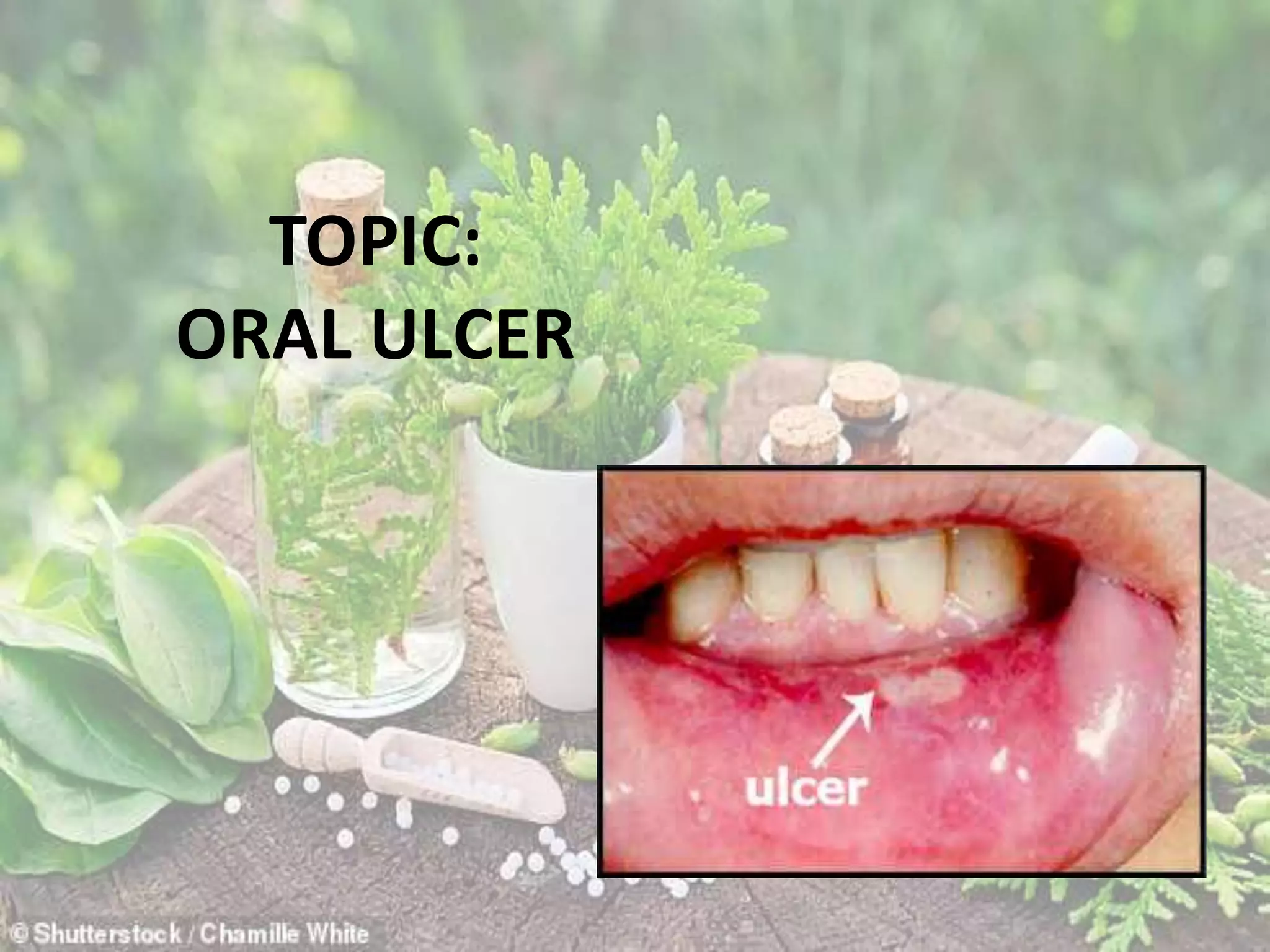 Oral ulcer | PDF