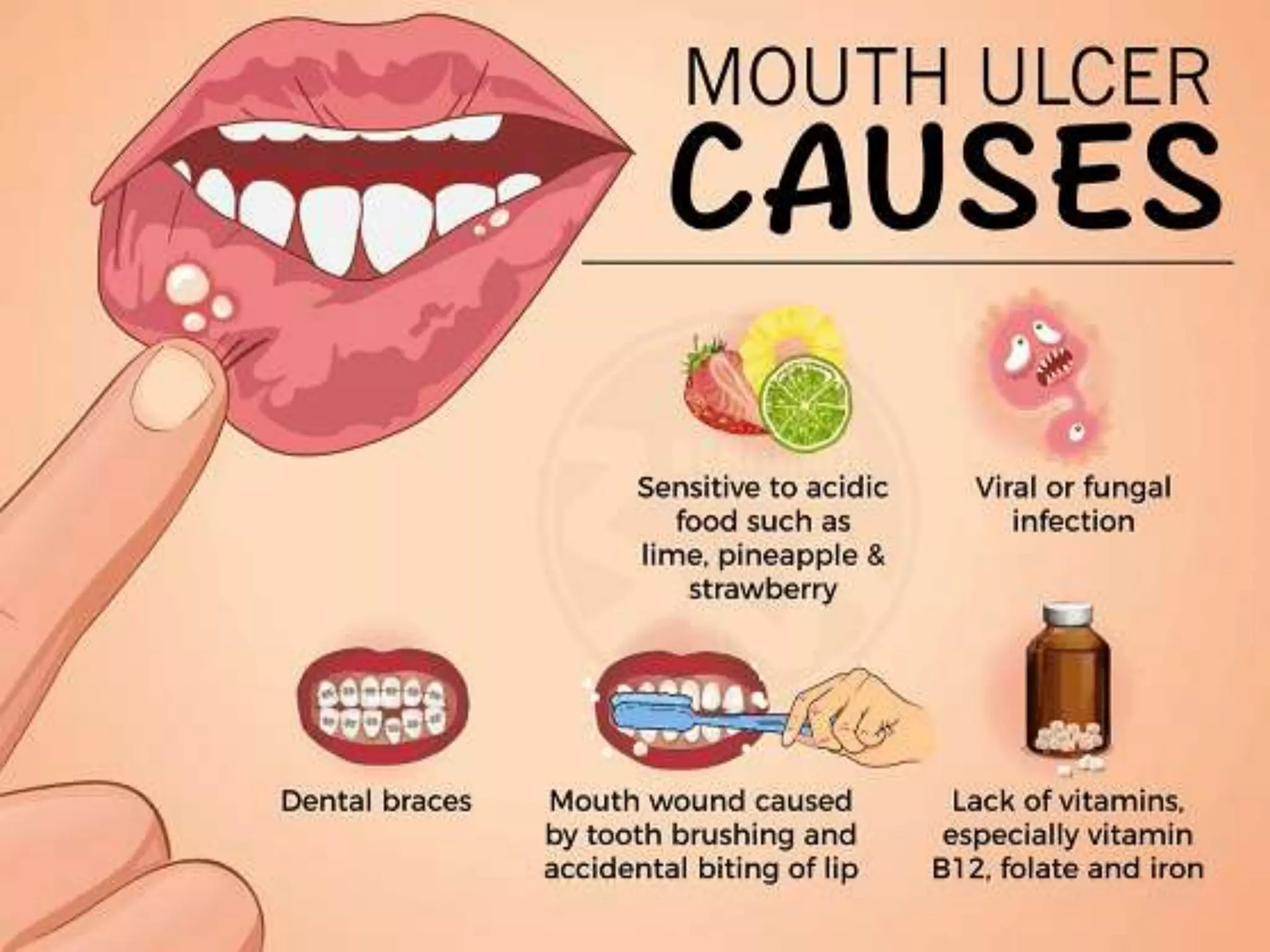 Oral ulcer | PDF