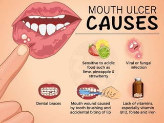 Oral ulcer | PDF