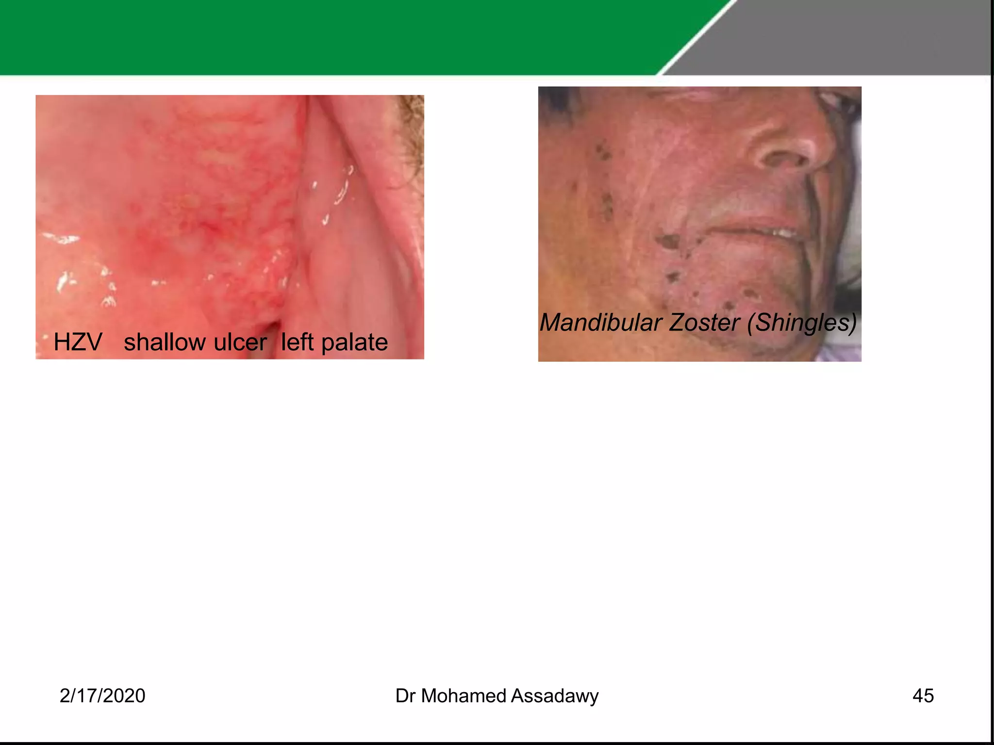 Oral ulceration Dr mohamed assadawy | PPTX
